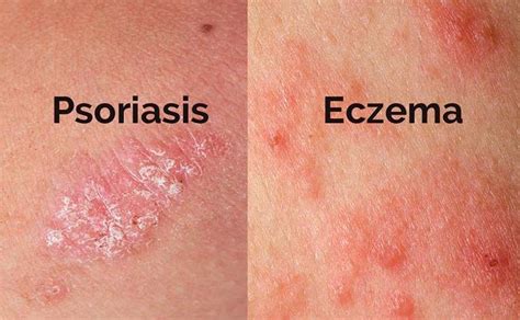Whats The Difference Between Psoriasis And Eczema Eczema Association