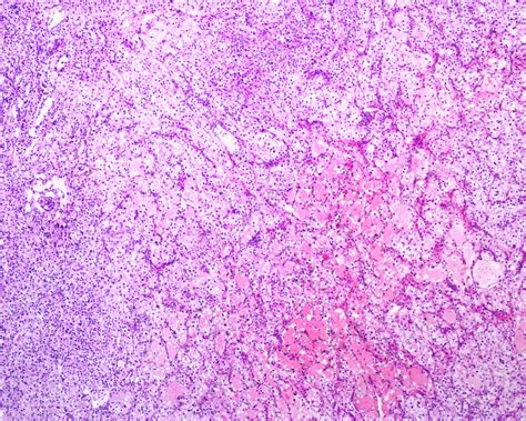 Hypernephroma Light Micrograph Stock Image C060 1435 Science Photo Library