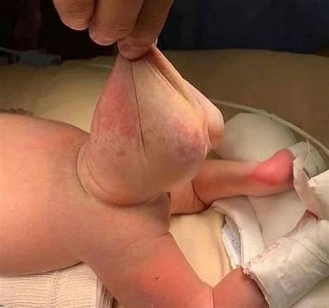 Myelomeningocele Often Referred To As A Neural Tube Defect Is A