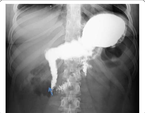 Barium Follow Through Shows Extrinsic Compression Of The Third Part Of