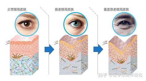 眼袋是怎么形成的？ 知乎