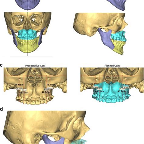 a 3d vsp used to confirm the treatment plan requiring bimaxillary