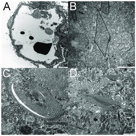 Transmission Electron Microscopy Tem Documents Podocyte Foot Process