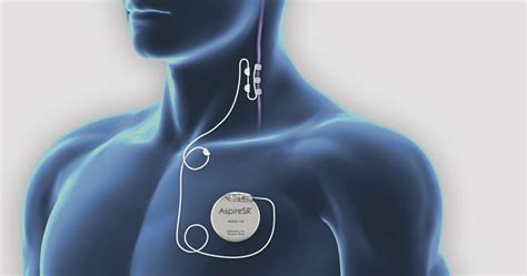 Vagus Nerve Stimulation VNS Epilepsy Society