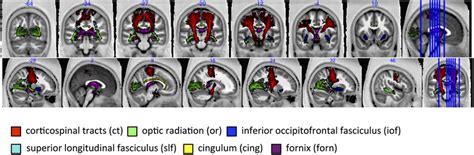 For Tract Specific Analyses Six Major White Matter Pathways Were