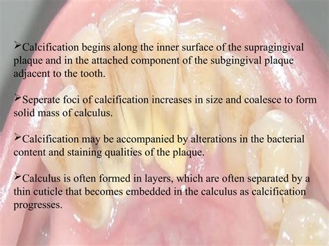 Calculus Calcification Of The Plaque Maturation Ppt