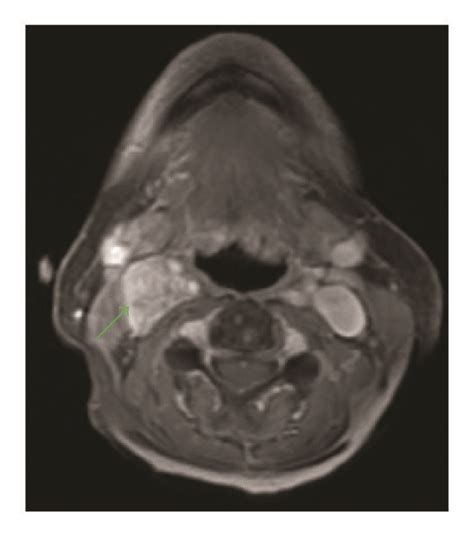 Mri Axial Section Fast Spoiled Gradient Echo With Contrast The Green