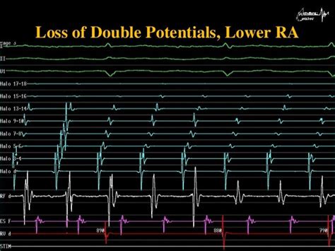 Ablation Of Atypical Flutter