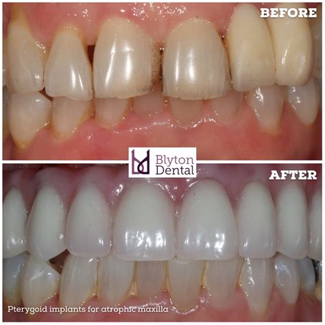 Pterygoid Implants For Atrophic Maxilla — Blyton Dental
