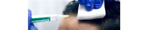 PRP Eigenbluttherapie bei Haarausfall KÖ HAIR