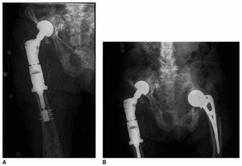 Allograft Prosthetic Composite And Endoprosthetic Replacement Of The