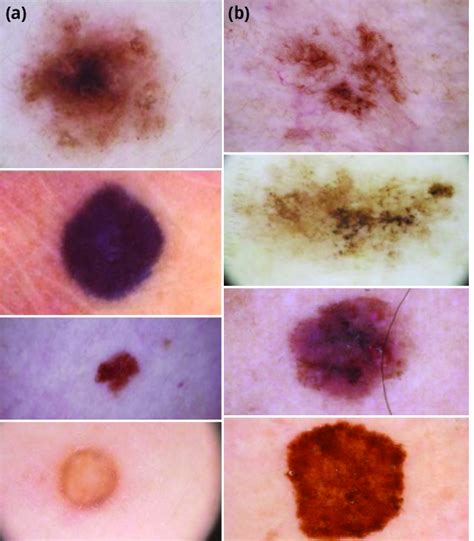 Skin Lesions A Benign Lesions B Malignant Lesions Melanoma