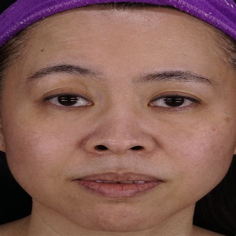 Eye Teartrough Dataset Object Detection Dataset By Face Iamges