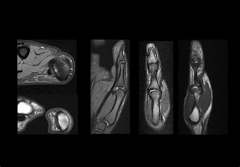 Ulnar Collateral Ligament Thumb Mri