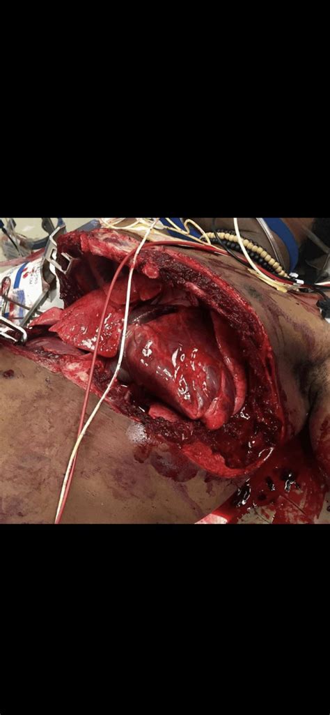 A Clamshell Thoracotomy Performed Due To A High Velocity Round To The Chest R Nsfl