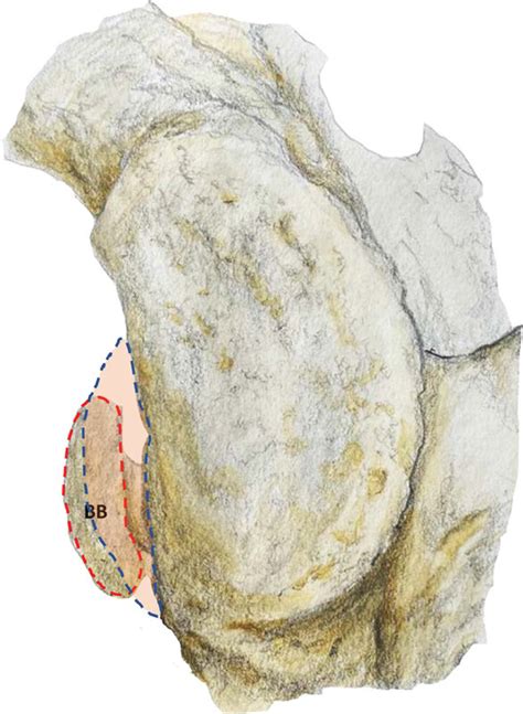 Illustration Of The Size Discrepancy Between The Glenoid Defect Blue