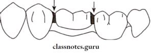 Fixed Partial Denture Class Notes