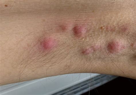 什么是化脓性汗腺炎附图片