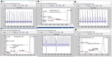 Detection Of Normal Bradycardia And Tachycardia Arrhythmias Of Signal