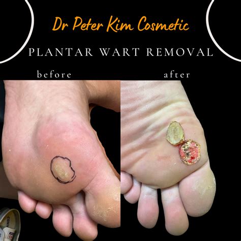 Laser Wart Removal And Treatment Sydney Finger Warts Plantar Warts