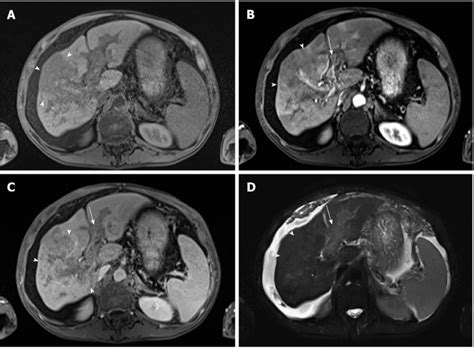 Diffuse Hepatocellular Carcinoma Associated With Tumor Thrombus A