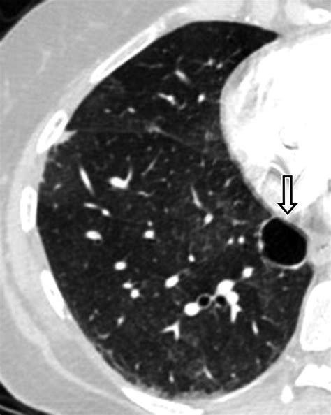 Pulmonary Hyperlucency In Adults Ajr