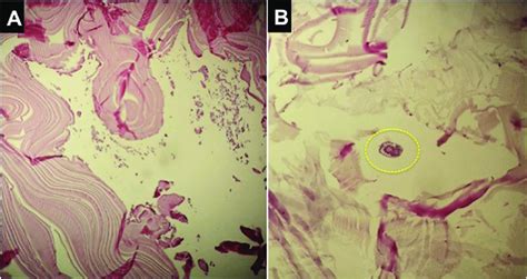 Microscopic Image Of Laminated Membrane Of Hydatid Cyst Hematoxylin