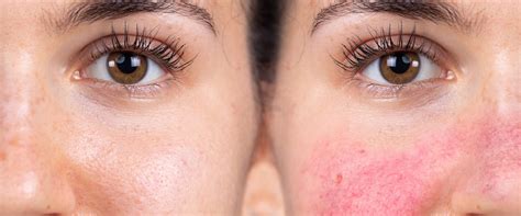 Understanding Rosacea Causes Symptoms And Treatment