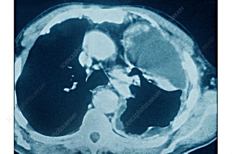 Ovarian Cancer Spread To Lymph Nodes In Groin