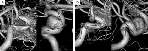 Measurement Of Anatomical Geometry In The Cavernous Ica By Download Scientific Diagram