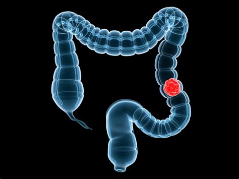 A New Look At Colon Cancer Screening Harvard Health