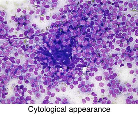 Pathology Outlines Ewing Sarcoma Pnet