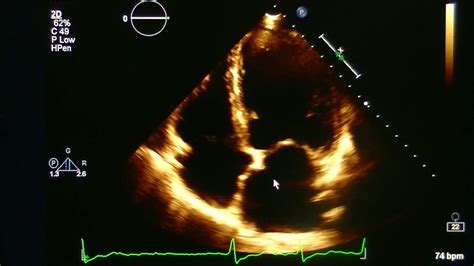 Echocardiogram With Atrial Fibrillation Practice Visual Estimation Ejection Fraction Youtube
