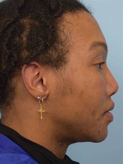 V Line Surgery Before After Patient Face Forward