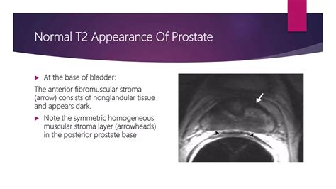 Multiparametric Mp Mri Of Prostate Cancer Pptx