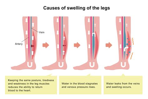 Medical Benefit Of Compression Garments And Compression Therapy Lipedema