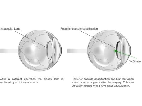 Eye Drops After Yag Laser At Palmer Ellerbee Blog