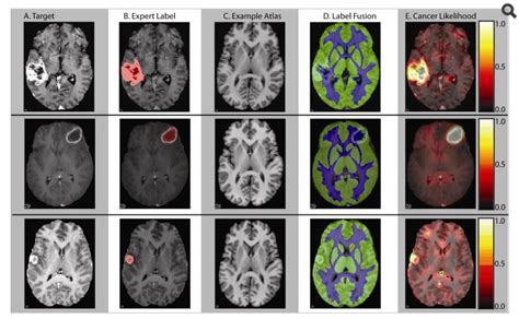 Out Of Atlas Labeling A Multi Atlas Approach To Cancer Segmentation Medical Image Analysis