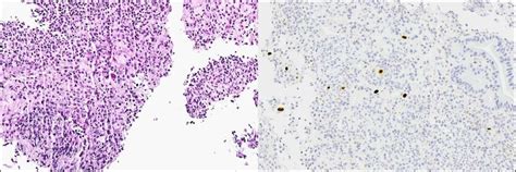 Gastric Mucosal Biopsies From Third Endoscopic Evaluation Completely
