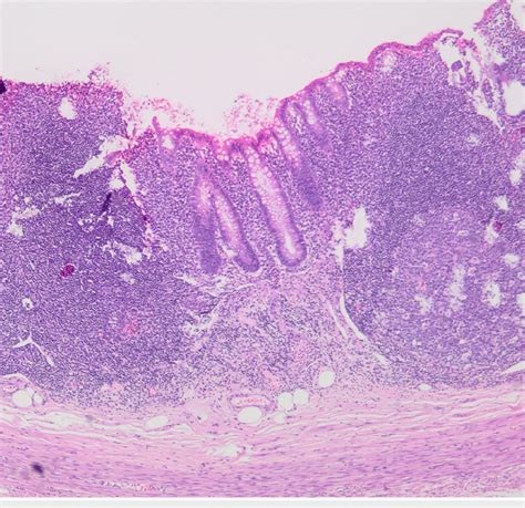 In The Appendix Intact Mucosa Lymphoid Tissue With The Enlarged