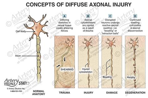 Concept Of Diffuse Axonal Injury Artery Studios