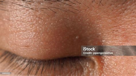 얼굴에 사마귀 눈 근처 사마귀의 매크로 샷 눈 코와 목 주위 피부에 유두종 모반 유두또는 두더지의 피부를 닫습니다 작은 하드 피부에 양성 성장 바이러스에 의해 발생 스킨케어