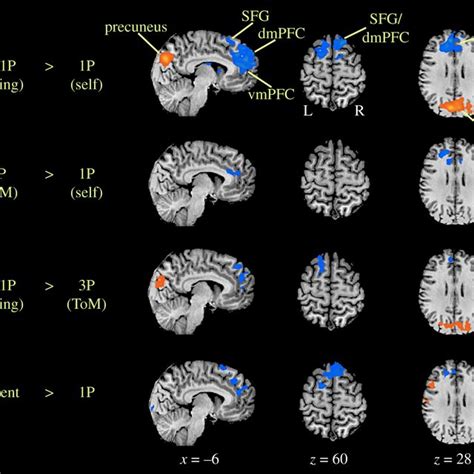 Brain Activations And Deactivations For The First Person 1p Task Download Scientific Diagram