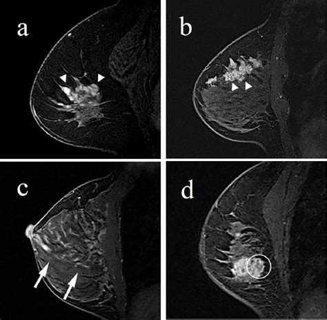 Figure 1 From Descriptors Of Malignant Non Mass Enhancement Of Breast