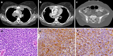 A 17 Year Old Female With An Incidentally Detected Anterior Mediastinal