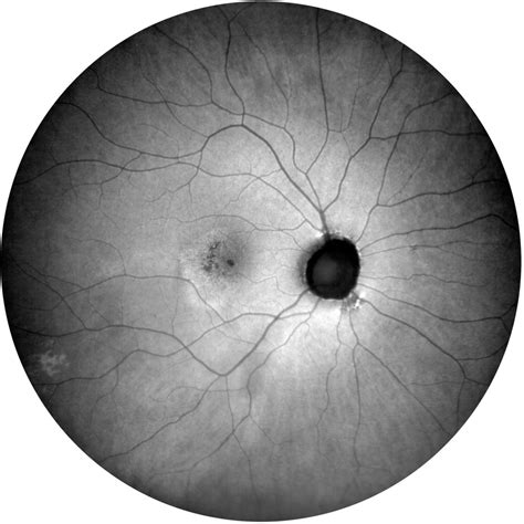 Clarus™ 500 Insumed