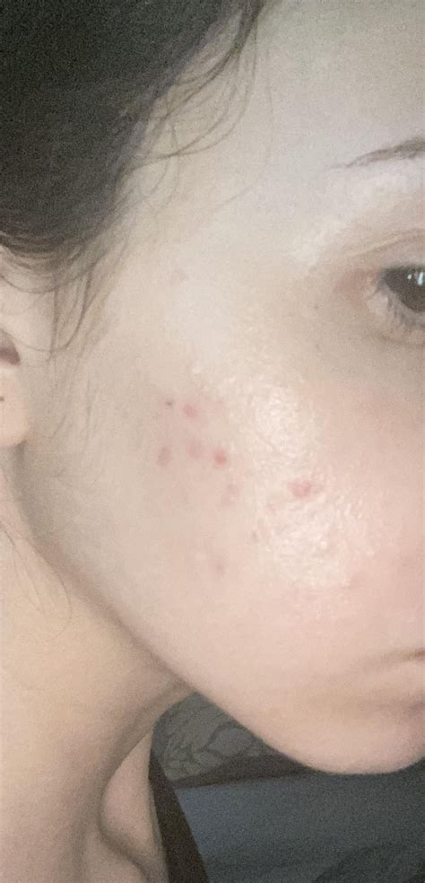 Ive Had The Same Acne On My Face For 2 Years Now It Doesnt Seem To
