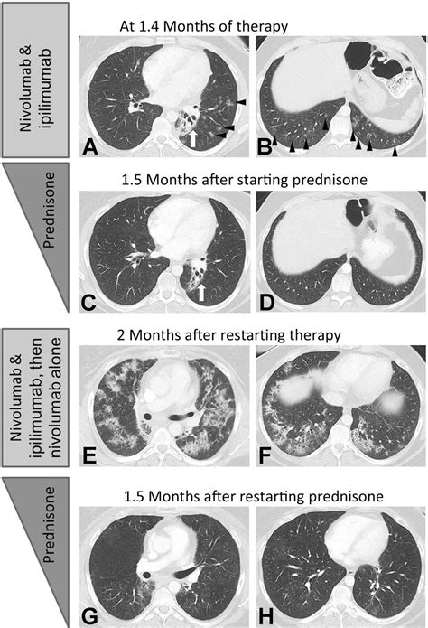 Chemical Pneumonitis Recovery Time At Doris Whitfield Blog