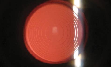 Panoptix Finevision And Rayone Diffractive Trifocal Intraocular Lenses