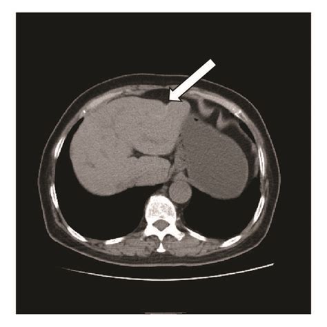 CT Scan Showing A Linear Calcification Consistent With Liver Fibrosis Download Scientific